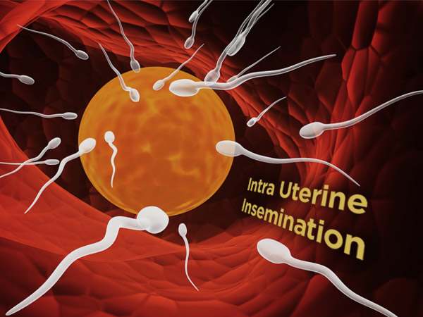 Problems Getting Pregnant - Talk About IUI (Intrauterine Insemination ...