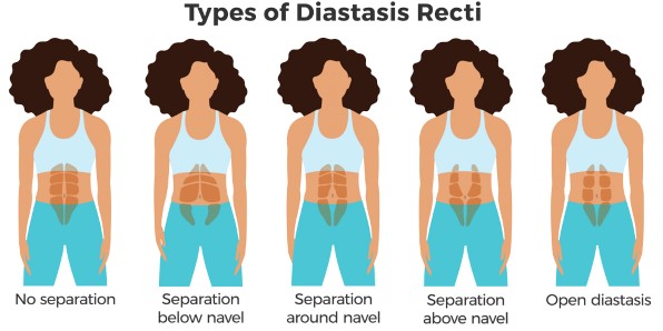 Diastasis-Recti-Chart-2020-1000x500 - OoWomaniya - Community Voices
